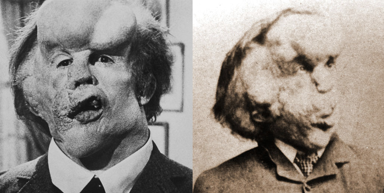The Elephant Man’s Untold Story